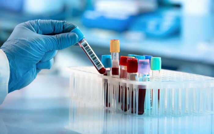 Understanding Blood Tests for Psoriatic Arthritis | Udaipur Kiran